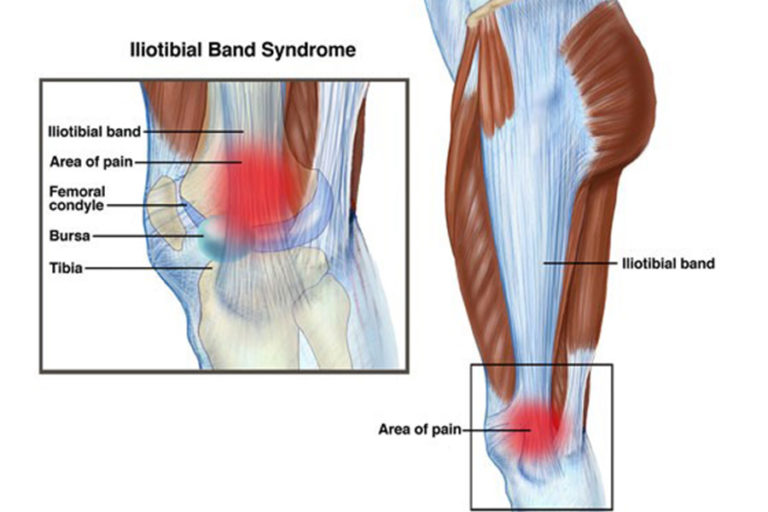 Σύνδρομο Λαγονοκνημιαίας Ταινίας (ΣΛΤ) - Δημήτρης Ηλιάδης
